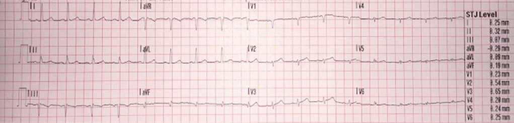 EKG patterns you may be missing – The Resus Room U.S.