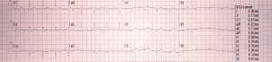 EKG patterns you may be missing – The Resus Room U.S.