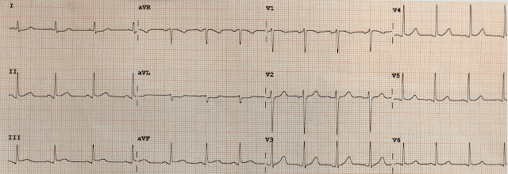 EKG patterns you may be missing – The Resus Room U.S.