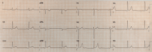 EKG patterns you may be missing – The Resus Room U.S.