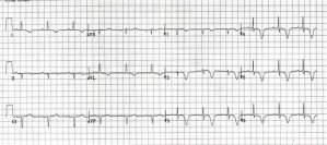 EKG patterns you may be missing – The Resus Room U.S.
